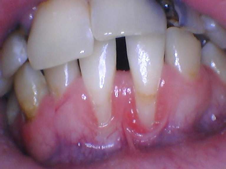Monett Neosho MO Dentist Before After Photos
